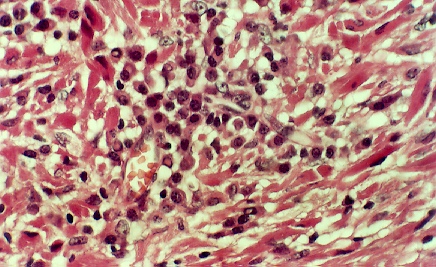 MORFOMETRIA DE LA HIPERPLASIA Y EL CARCINOMA DUCTAL DE MAMA
