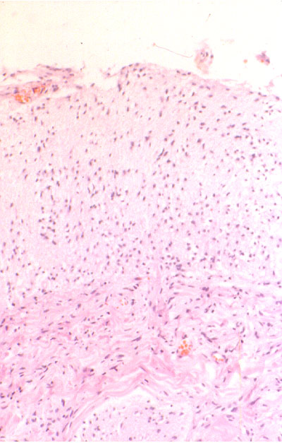 SARCOMA SINOVIAL INTRAARTICULAR