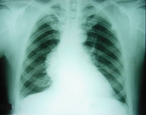 V Congreso Virtual Hispanoamericano de Anatomía Patológica CARCINOMA ...