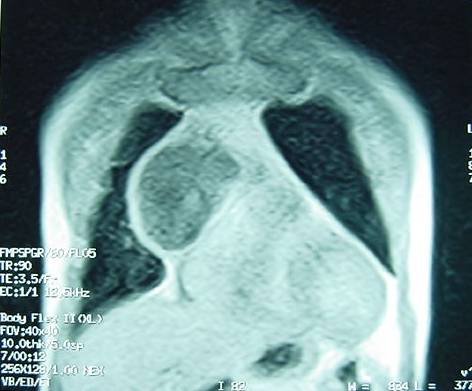 V Congreso Virtual Hispanoamericano de Anatomía Patológica CARCINOMA ...