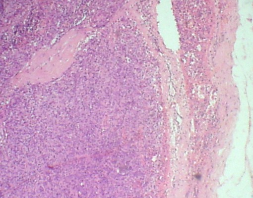 V Congreso Virtual Hispanoamericano de Anatomía Patológica CARCINOMA ...