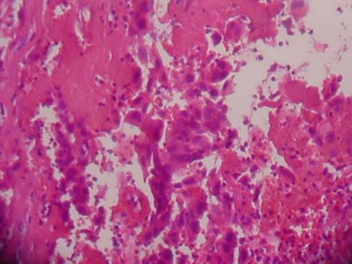 V Congreso Virtual Hispanoamericano de Anatomía Patológica CARCINOMA ...