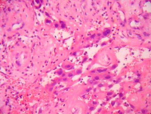 V Congreso Virtual Hispanoamericano de Anatomía Patológica CARCINOMA ...