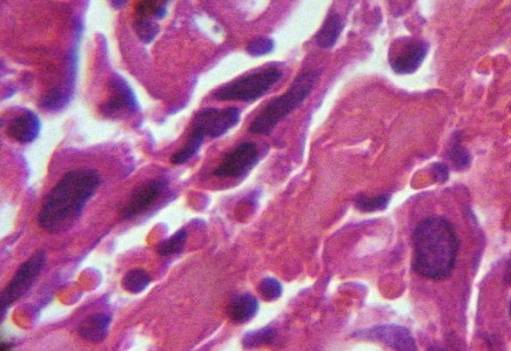 V Congreso Virtual Hispanoamericano de Anatomía Patológica CARCINOMA ...