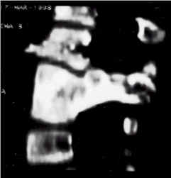 DIASTEMATOMIELIA: UNA FORMA DE DISRAFIA ESPINAL.