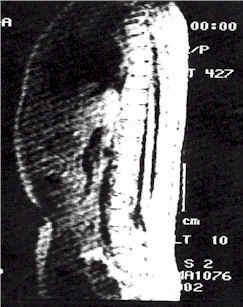 DIASTEMATOMIELIA: UNA FORMA DE DISRAFIA ESPINAL.