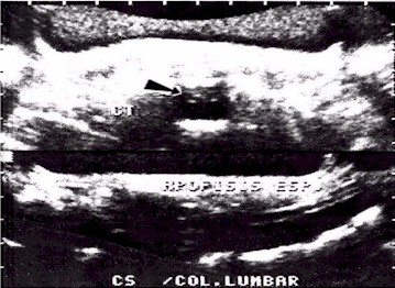 DIASTEMATOMIELIA: UNA FORMA DE DISRAFIA ESPINAL.