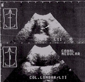 DIASTEMATOMIELIA: UNA FORMA DE DISRAFIA ESPINAL.