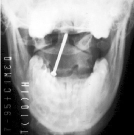 FIJACION ANTERIOR PERCUTANEA DE ODONOTOIDES.